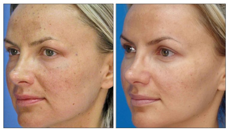 sciton-laser-skin-before-after-3 - Carolina Coastal Plastic Surgery
